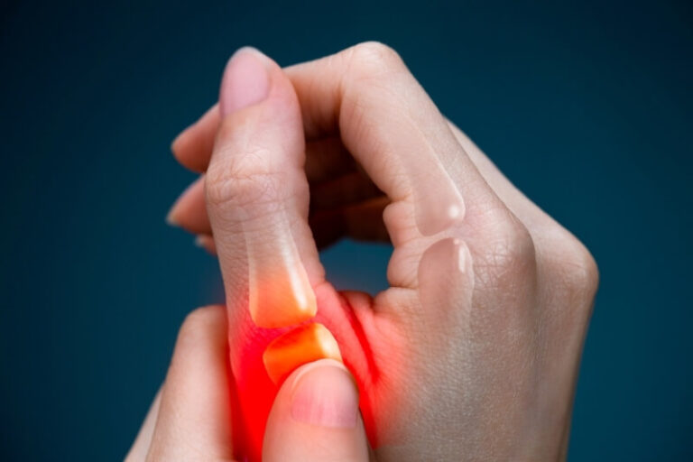 Understanding Trigger Finger: Symptoms, Causes, and How Physiotherapy ...